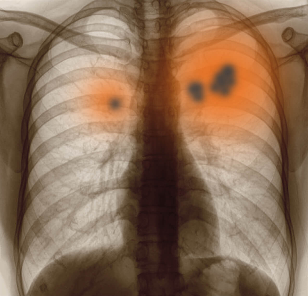Emphysema Diagnosis